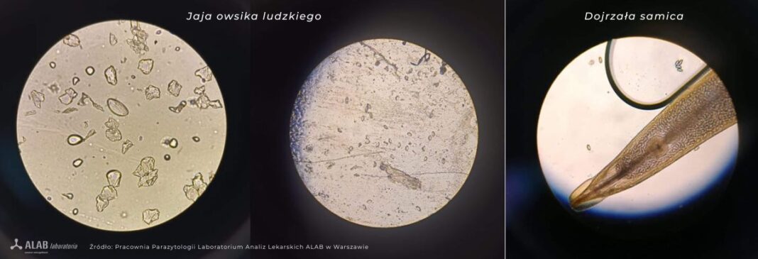 Owsiki - drogi zakażenia, objawy, diagnostyka i leczenie owsicy