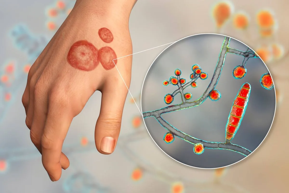 Grzybice skóry - przyczyny, objawy, rodzaje