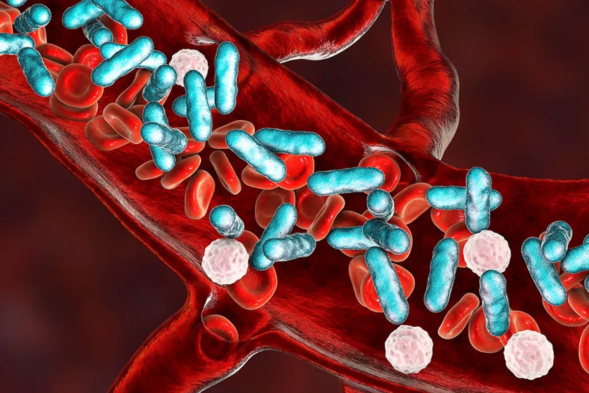 Sepsa – objawy, przyczyny i leczenie posocznicy - Centrum Wiedzy ALAB ...
