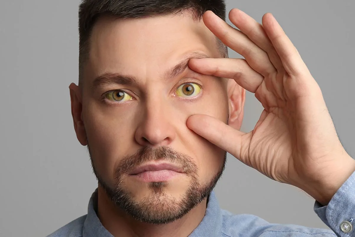 Żółtaczka - przyczyny, rodzaje, diagnostyka hiperbilirubinemii