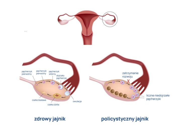 Zespół policystycznych jajników (PCOS) - objawy, diagnostyka