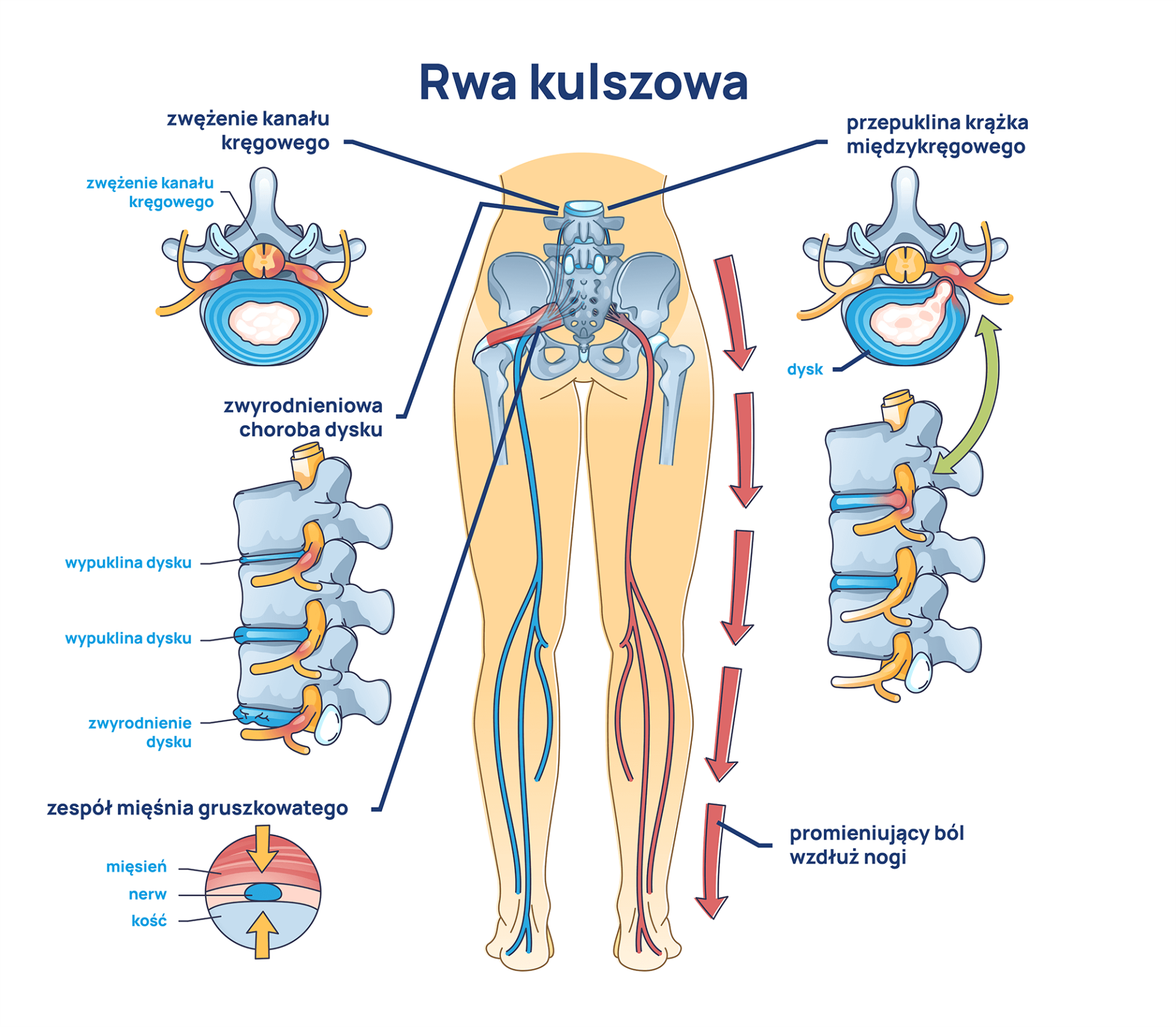 Rwa kulszowa – przyczyny, objawy, leczenie - Centrum Wiedzy ALAB ...