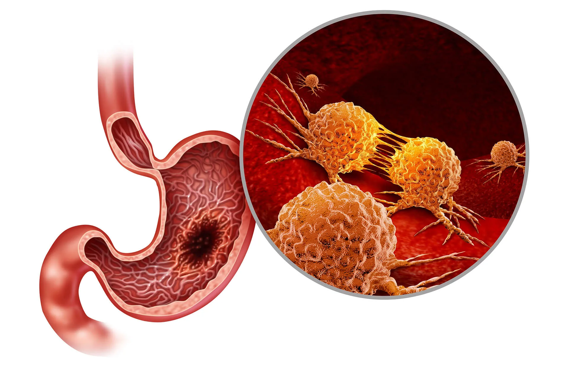Rak żołądka – przyczyny, objawy, diagnostyka, leczenie - Centrum Wiedzy ...