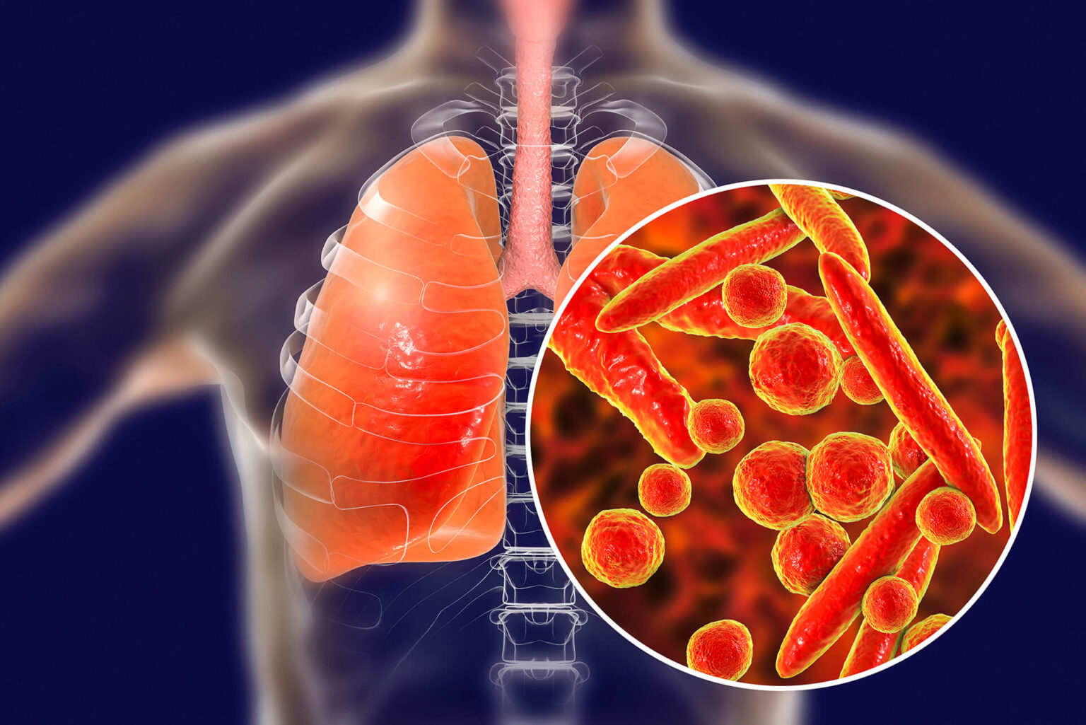 Mykoplazma u dzieci i dorosłych – objawy, diagnostyka, leczenie ...