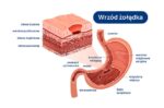 Wrzody żołądka - objawy, przyczyny, badania i leczenie choroby ...