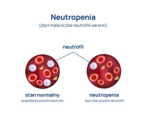 Neutropenia (niski poziom neutrofili): przyczyny, objawy, leczenie