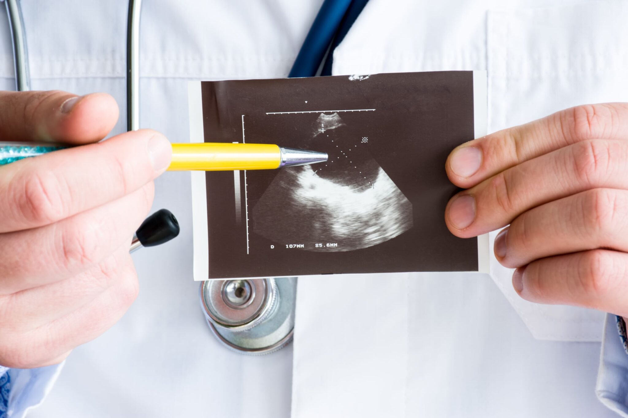 Torbiel na trzustce – objawy, przyczyny, diagnostyka i leczenie ...