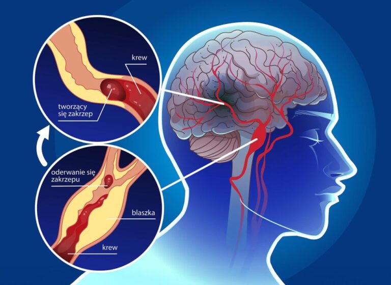 Udar mózgu – objawy, przyczyny, pierwsza pomoc i profilaktyka - Centrum ...