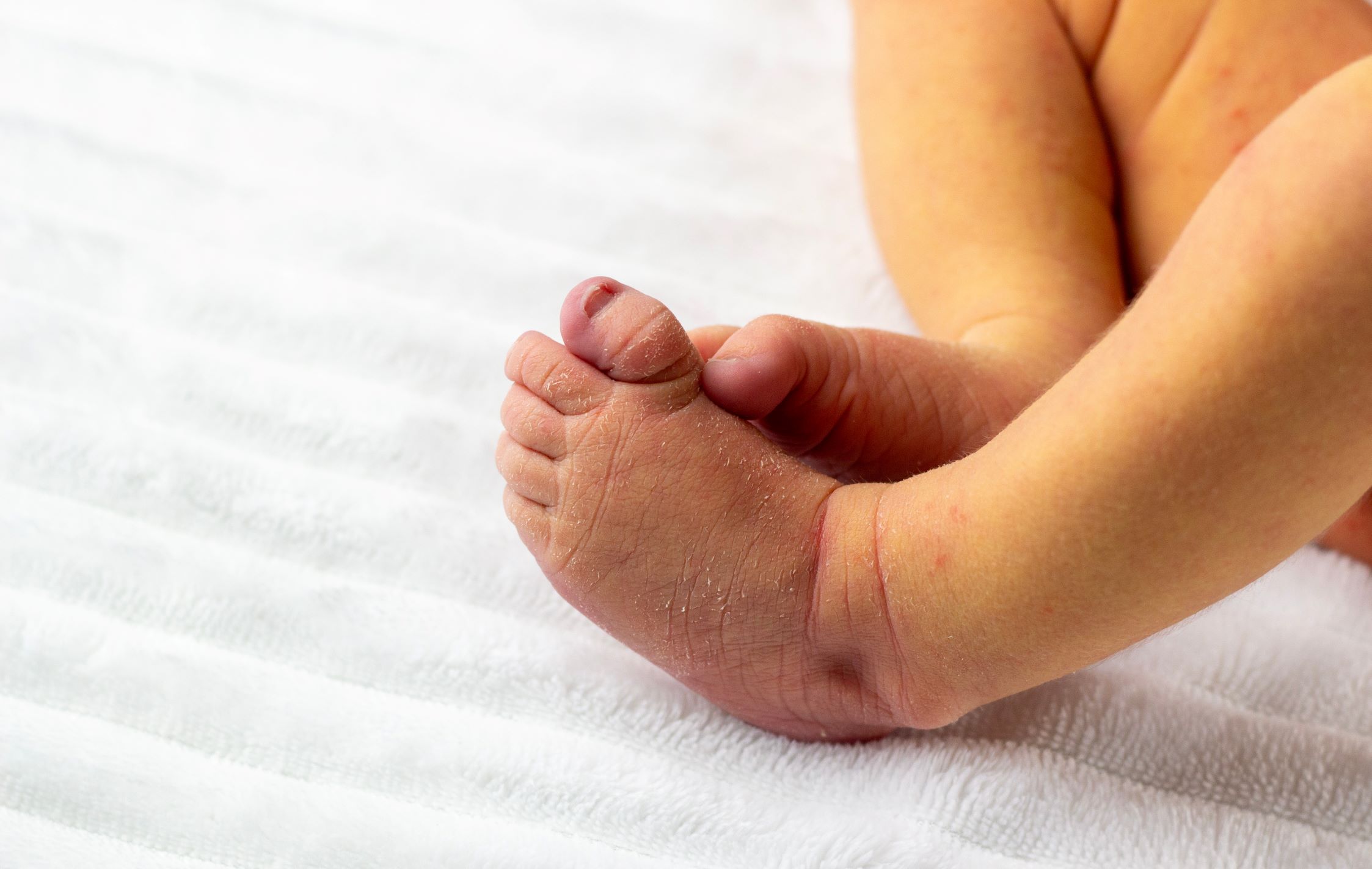 Przyczyny występowania żółtaczek noworodkowych - Centrum Wiedzy ALAB ...