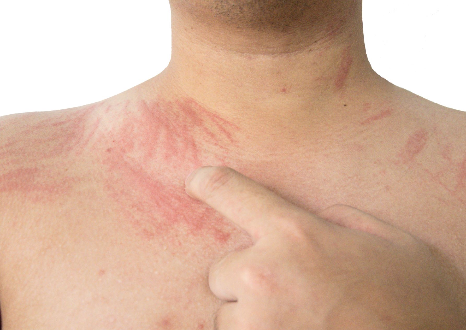 Pokrzywka dermograficzna (dermografizm) - co to jest? Objawy, przyczyny ...