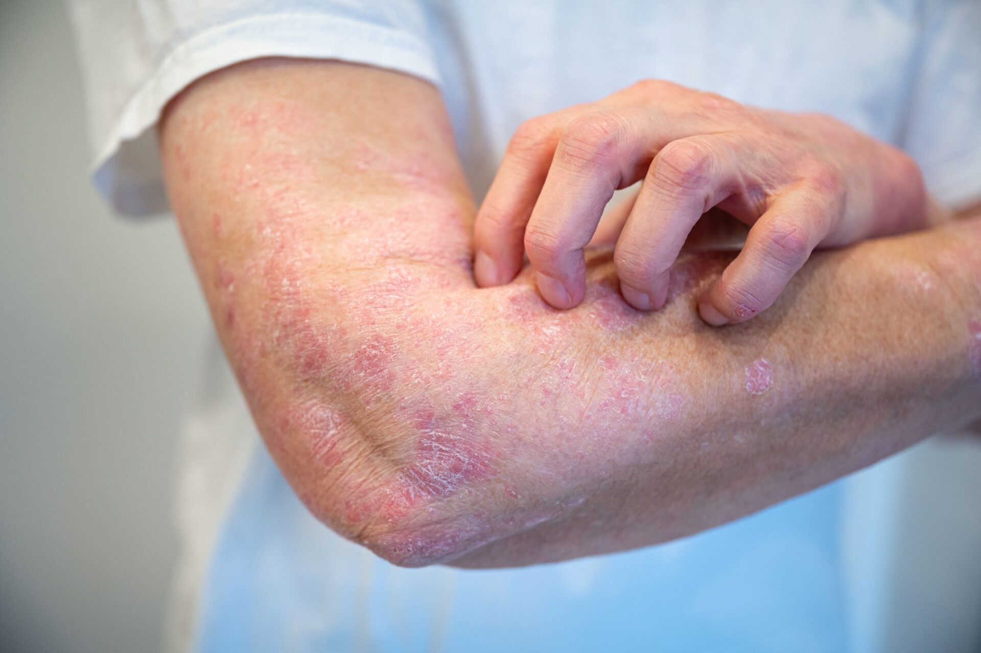 Choroby skóry u człowieka. Najczęściej występujące dermatozy - Centrum ...