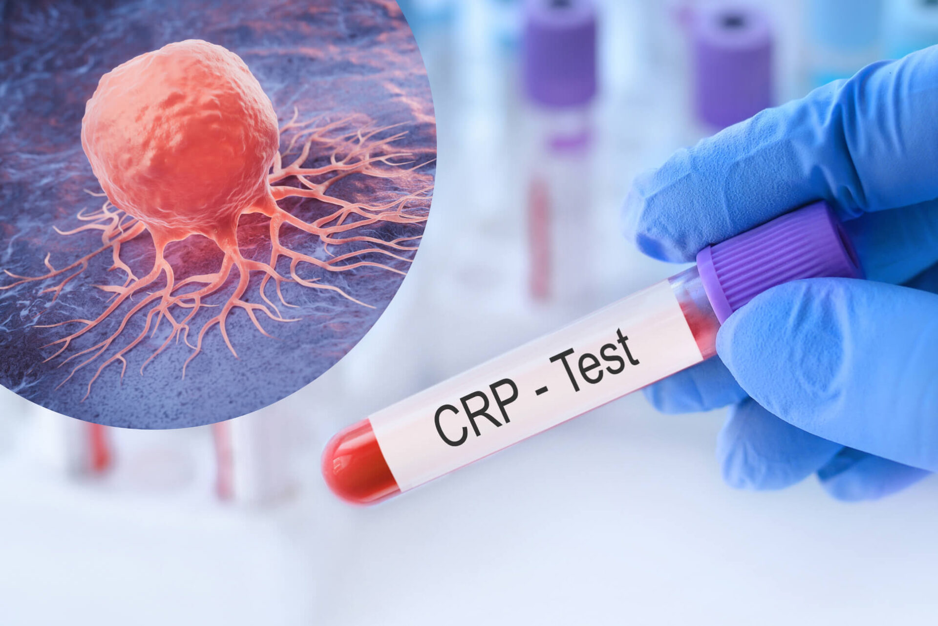 CRP a rak. Jakie nowotwory korelują z podwyższonym CRP? - Centrum ...