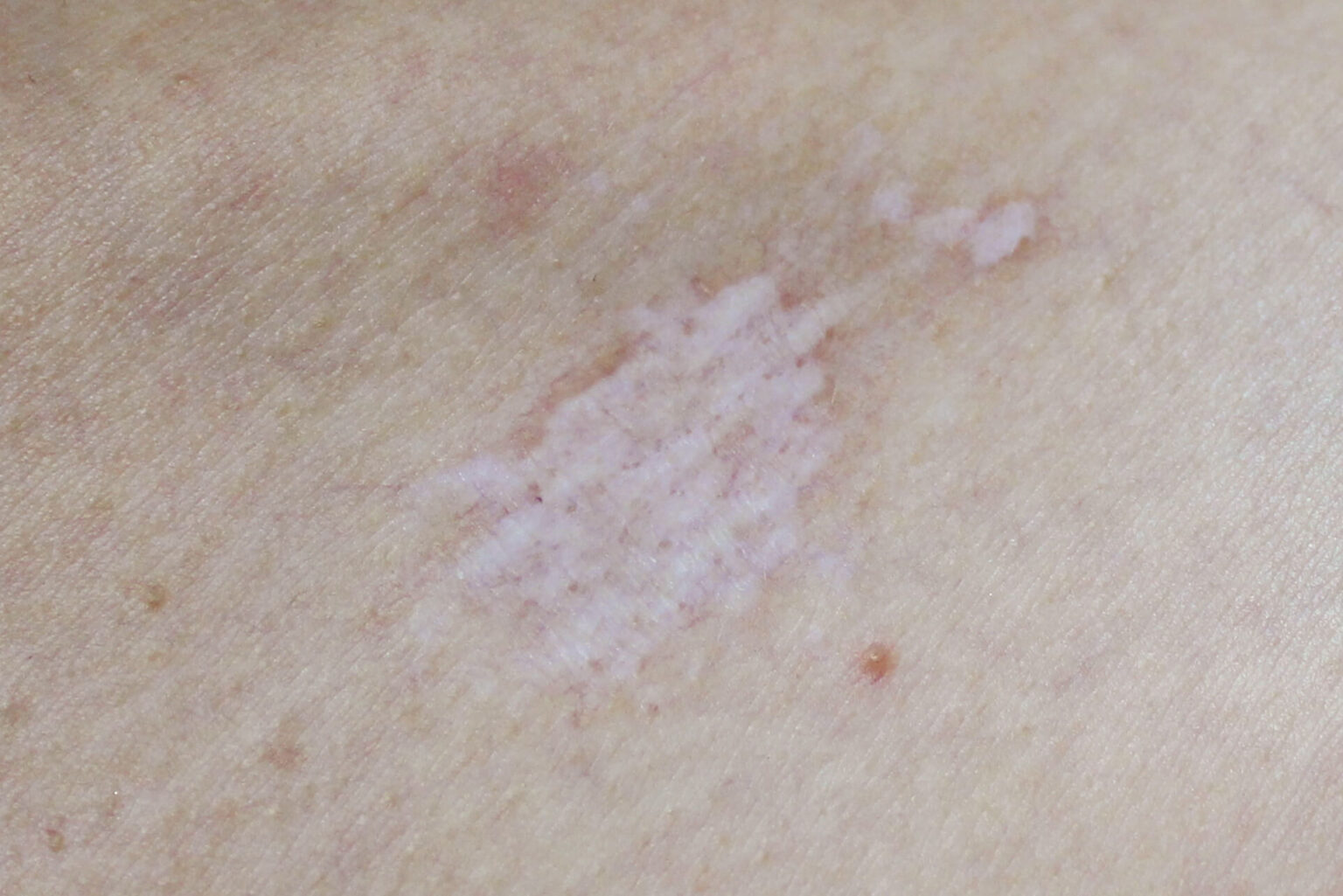 Liszaj twardzinowy: objawy, przyczyny i leczenie - Centrum Wiedzy ALAB ...