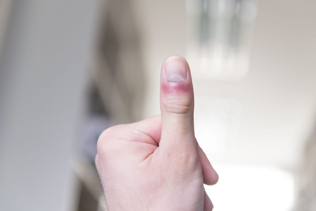 Zastrzał palca: przyczyny, objawy i leczenie zastrzału - Centrum Wiedzy ...
