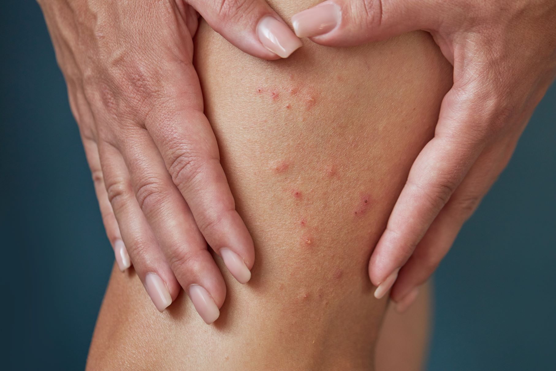 Krosty na nogach – skąd się biorą i co mogą oznaczać? - Centrum Wiedzy ...