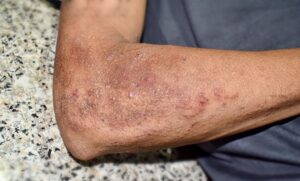 Pelagra (rumień lombardzki) – co to jest? Objawy, diagnostyka, leczenie ...