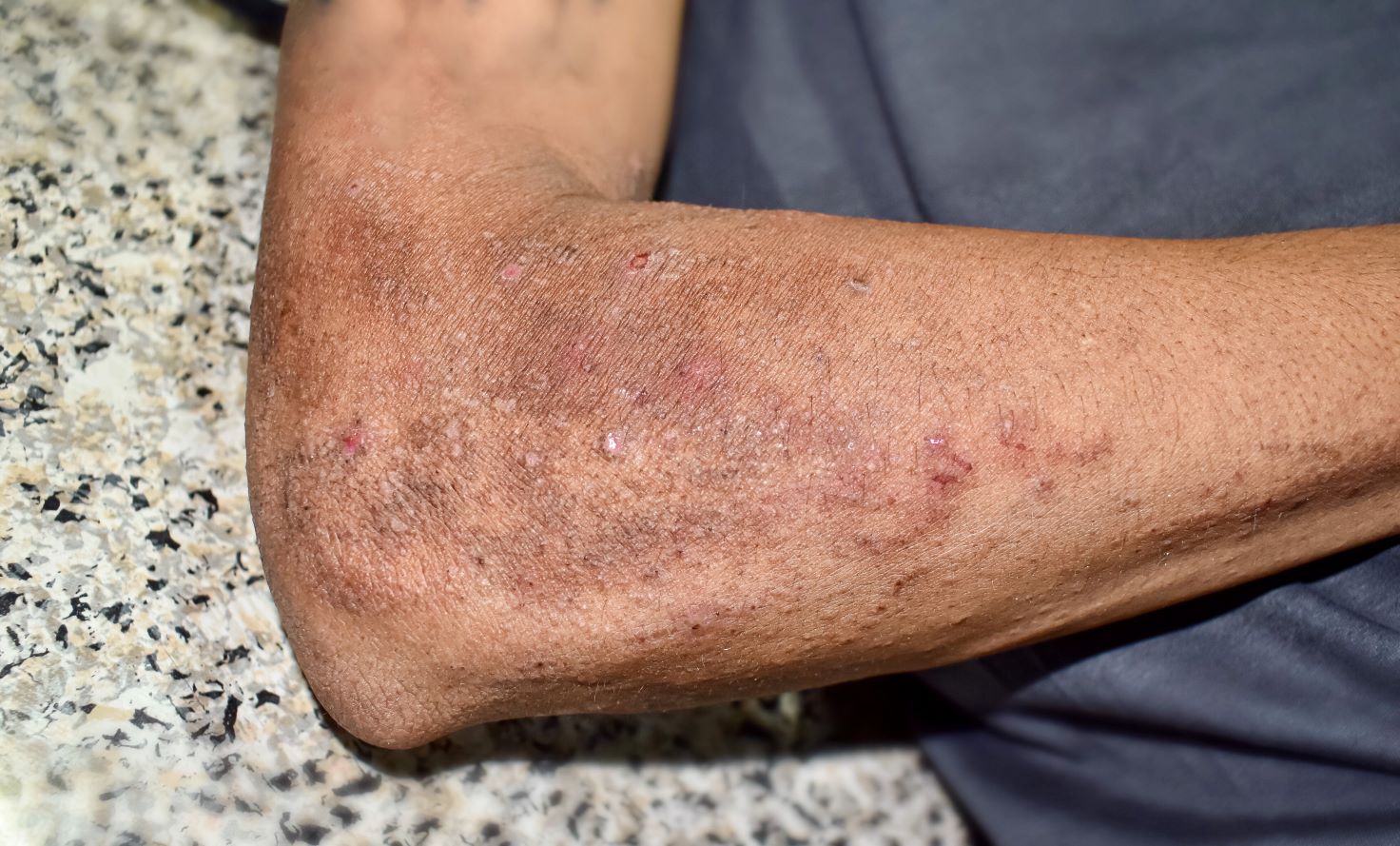 Pelagra (rumień lombardzki) – co to jest? Objawy, diagnostyka, leczenie ...