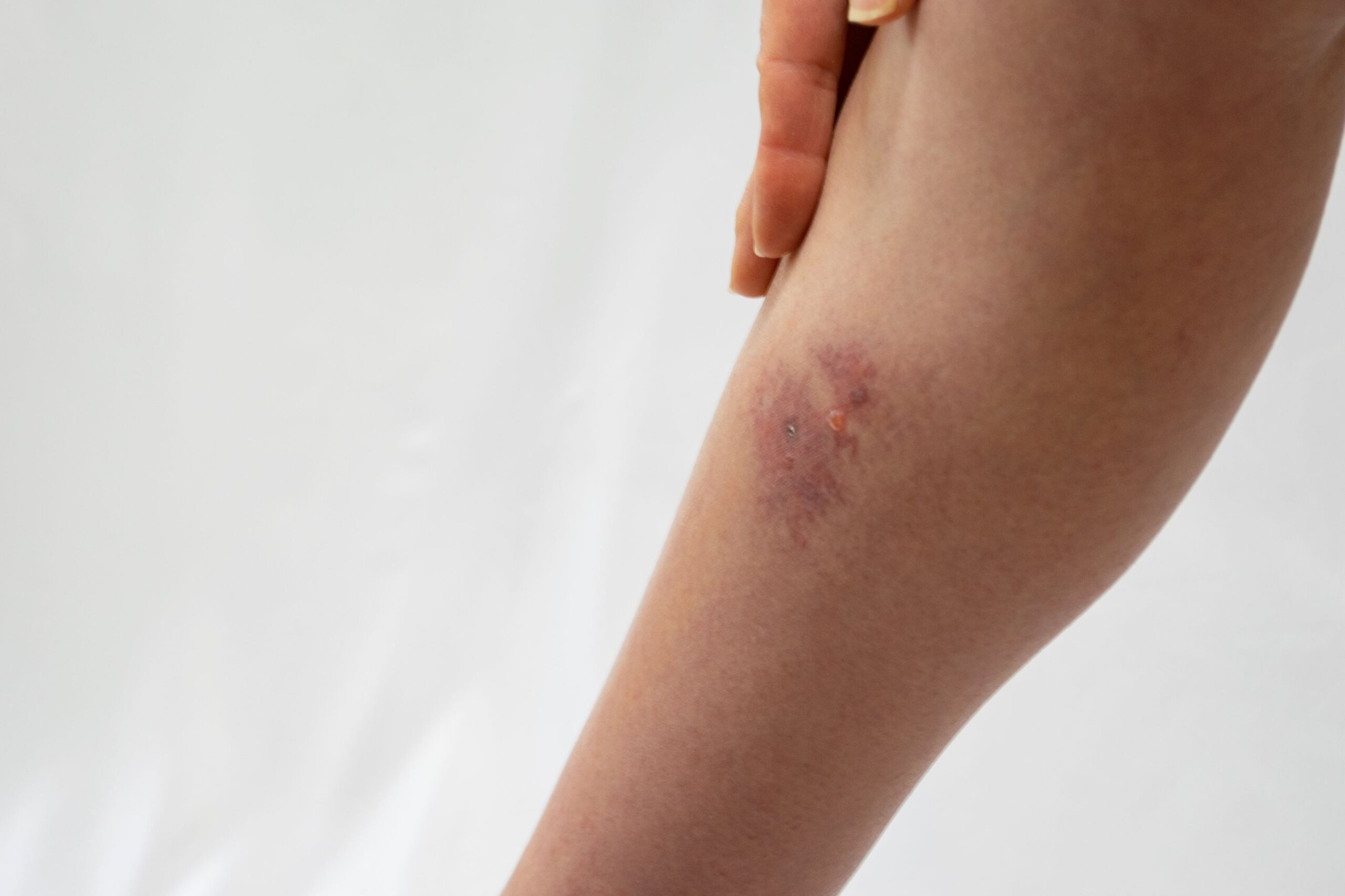 Ropowica (flegmona): czym jest i jakie daje objawy? - Centrum Wiedzy ...