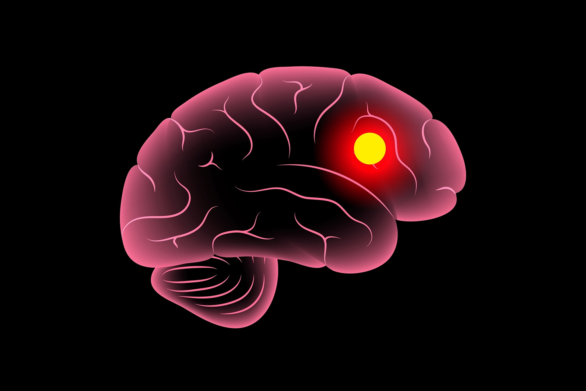 Glejak mózgu – objawy, przyczyny, diagnostyka i leczenie - Centrum ...