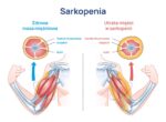 Sarkopenia – przyczyny, objawy, diagnostyka, leczenie - Centrum Wiedzy ...