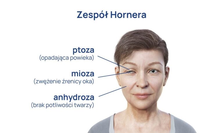 Zespół Hornera – jakie są jego objawy i przyczyny. Diagnostyka i ...